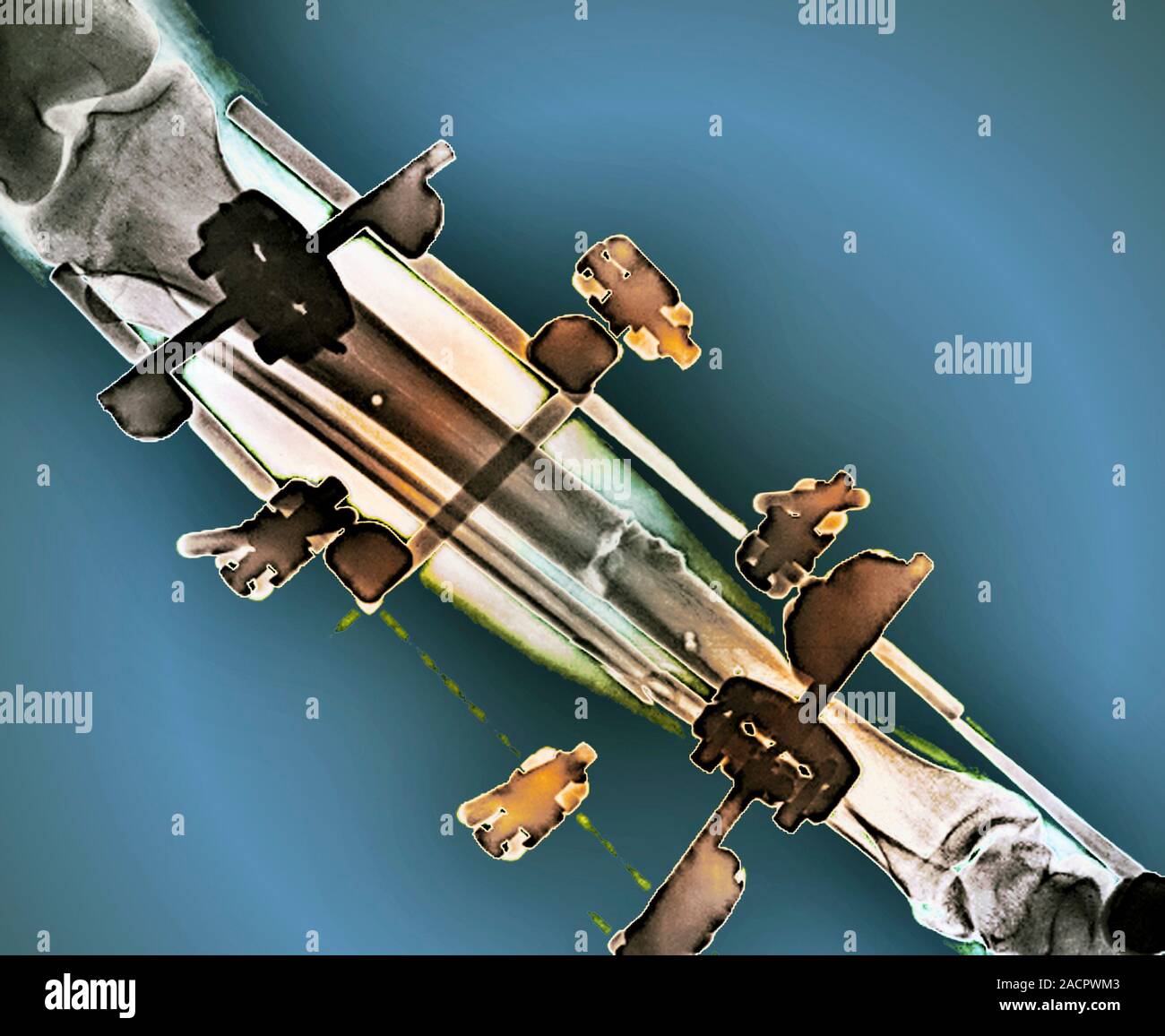 Pinned leg fracture. X-ray of the leg of a 33 year old patient that has ...
