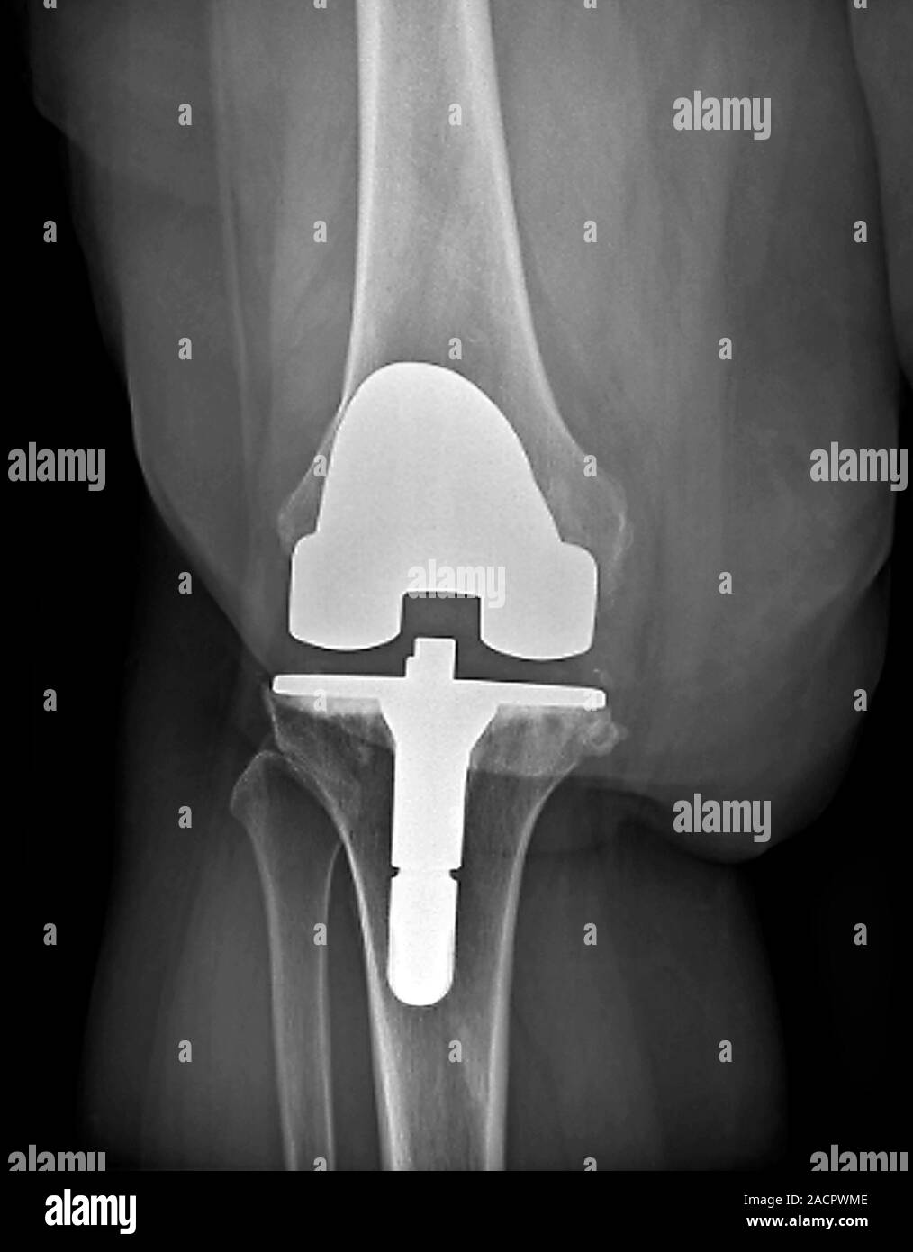 Prosthetic knee and obesity. X-ray of a prosthetic knee joint (white ...