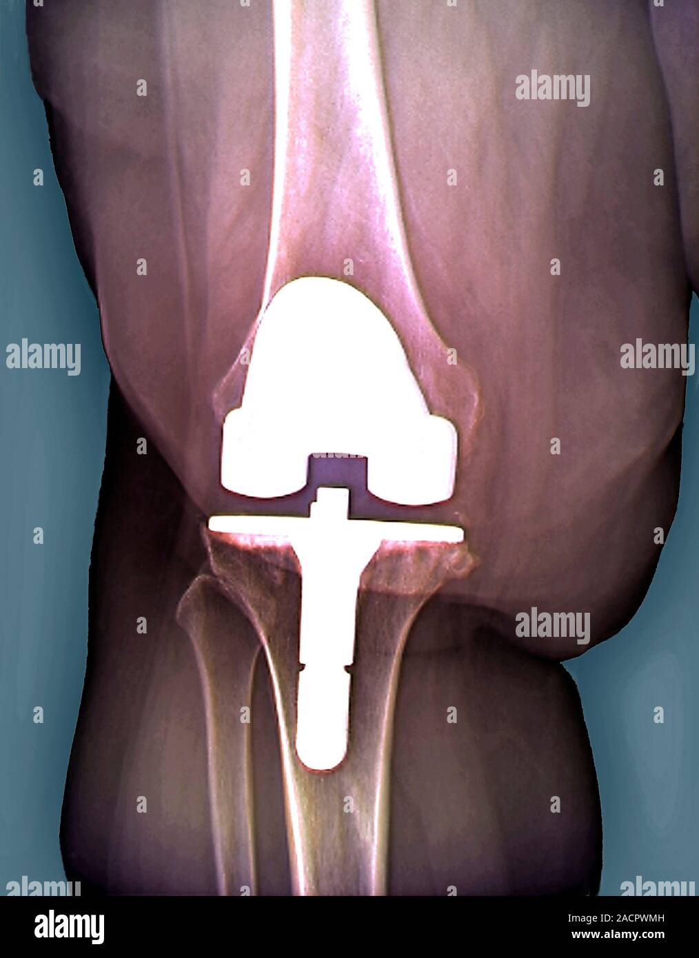 Prosthetic knee and obesity. Coloured X-ray of a prosthetic knee joint ...