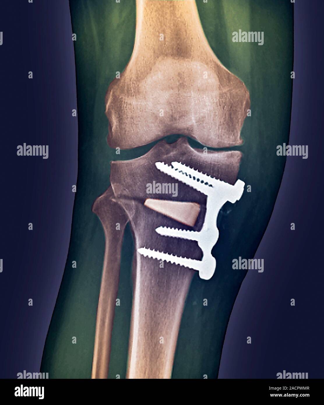 Knee alignment surgery. Coloured X-ray of the knee of a 55 year old ...