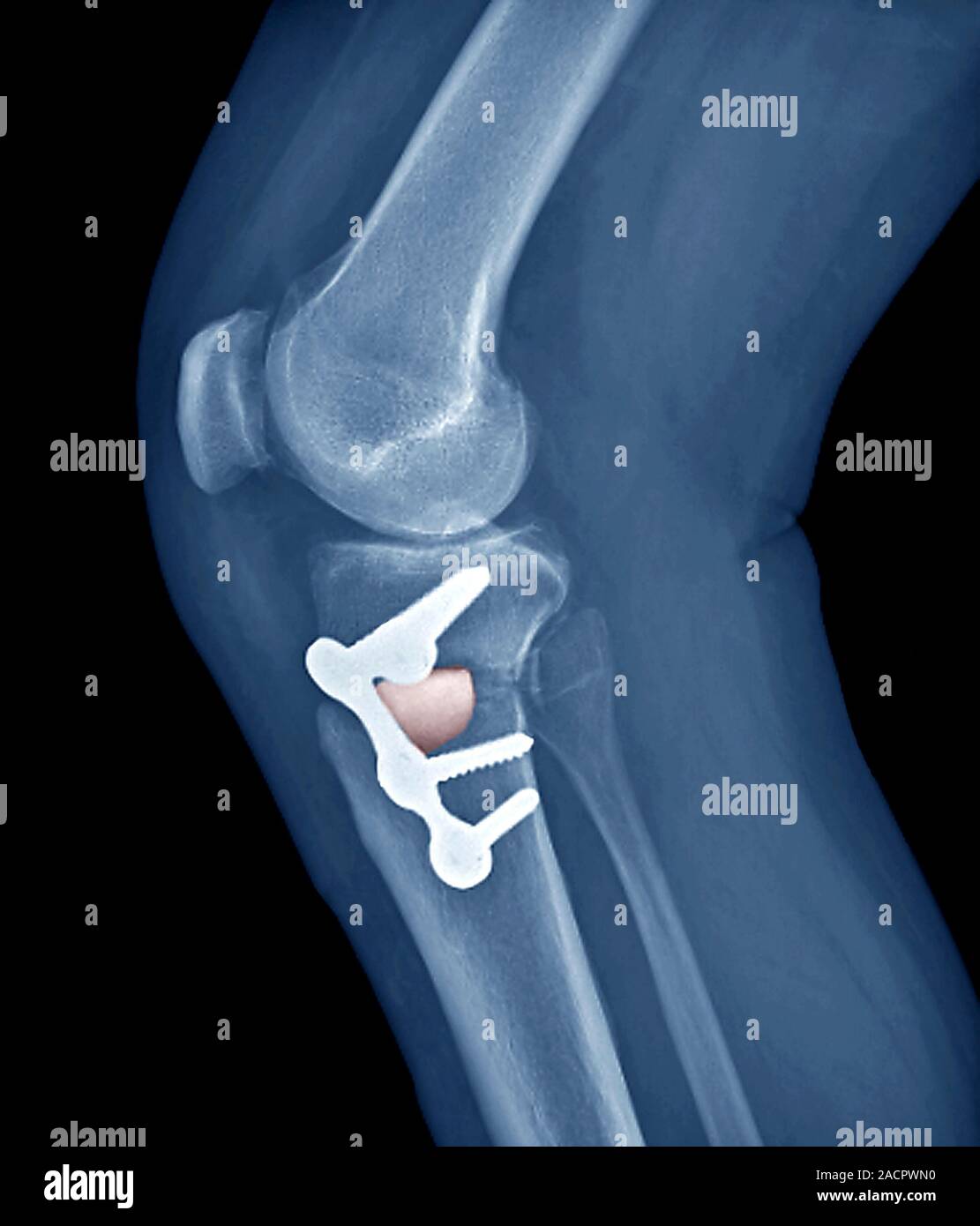 Knee alignment surgery. Coloured X-ray of the knee of a 55 year old ...