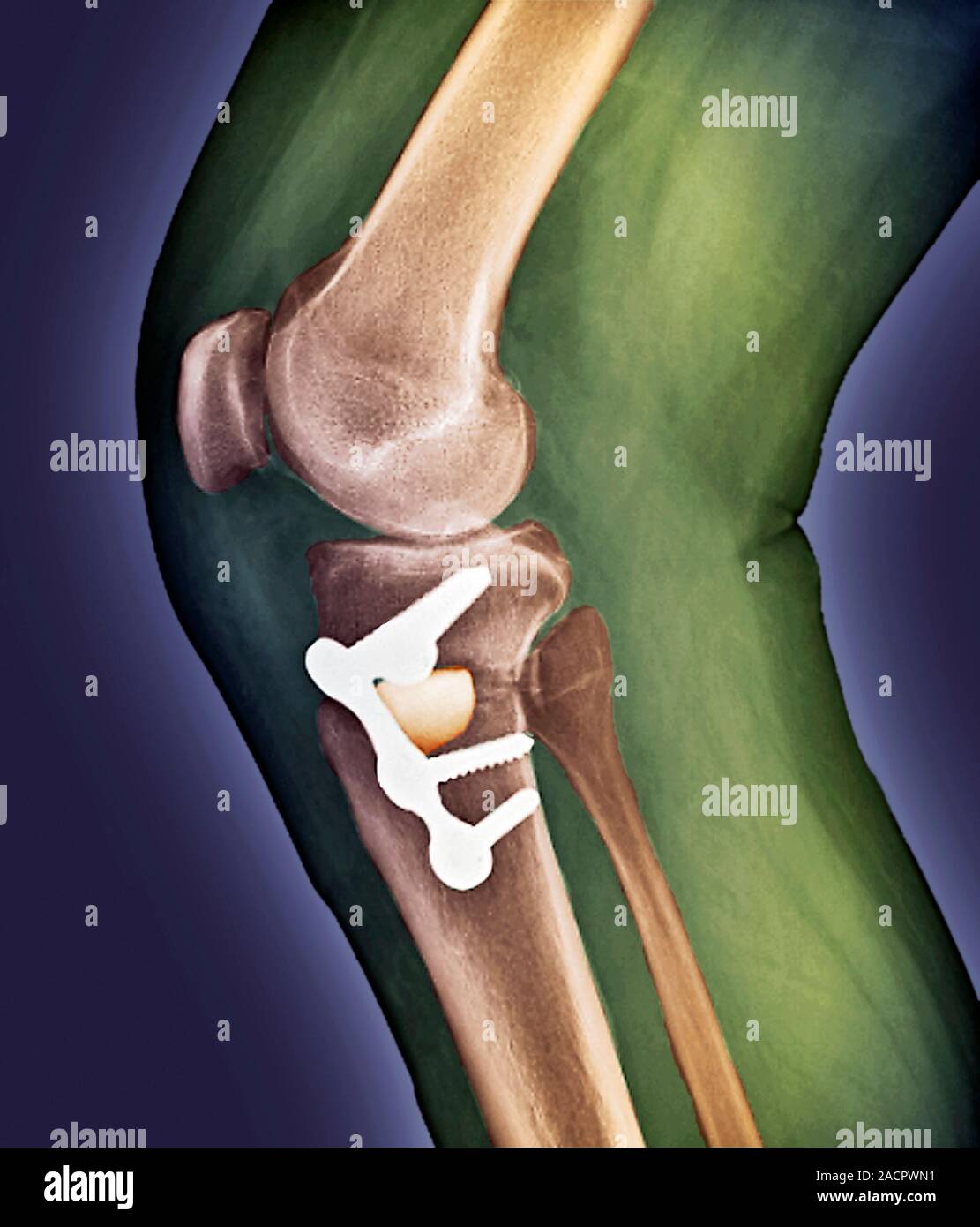 Knee alignment surgery. Coloured X-ray of the knee of a 55 year old ...