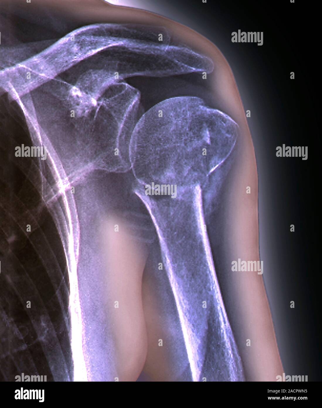 Fractured and dislocated shoulder. Coloured X-ray of the shoulder of a ...
