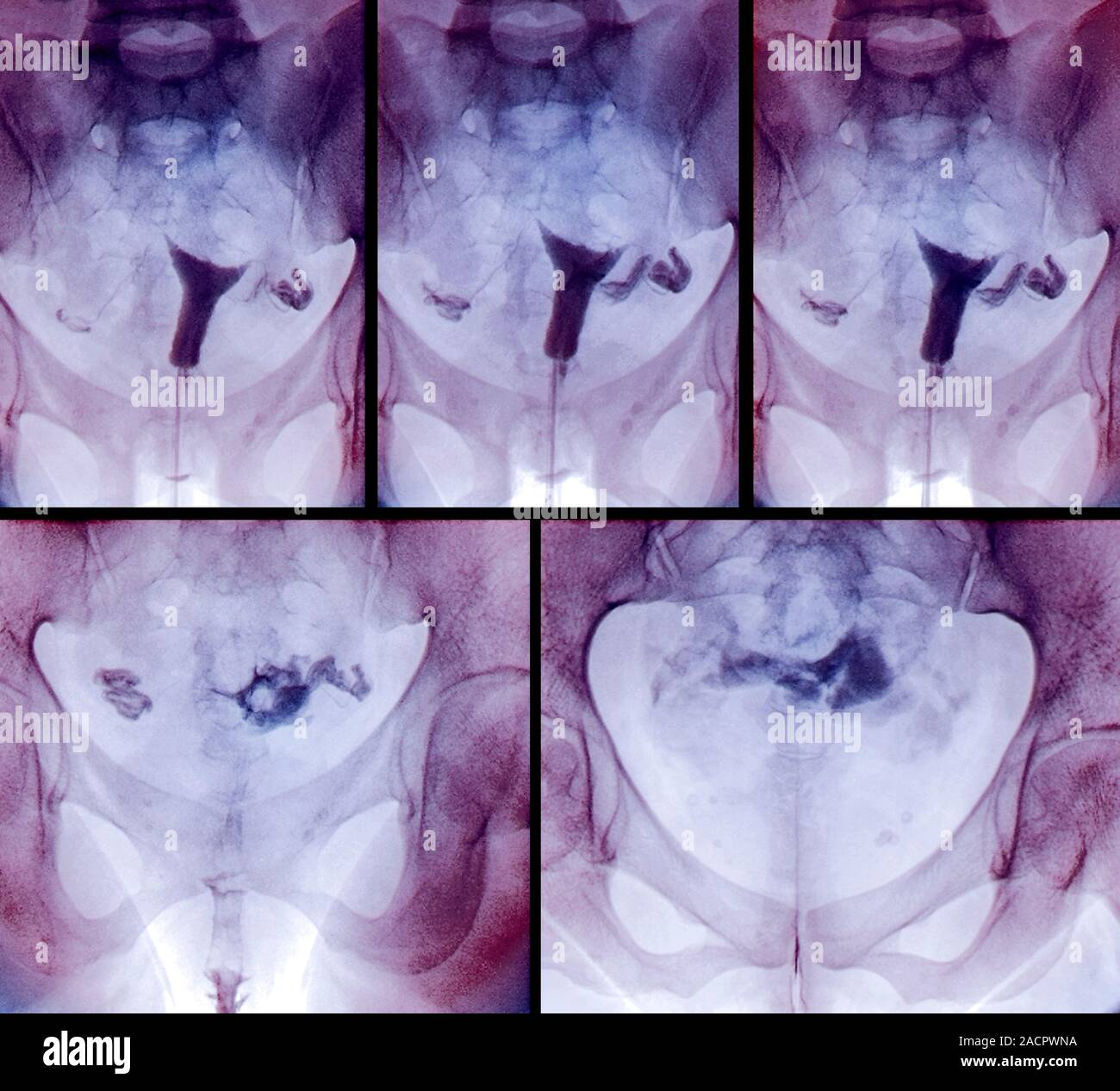 Blocked fallopian tubes. Coloured hysterosalpingogram (X-ray) of the ...