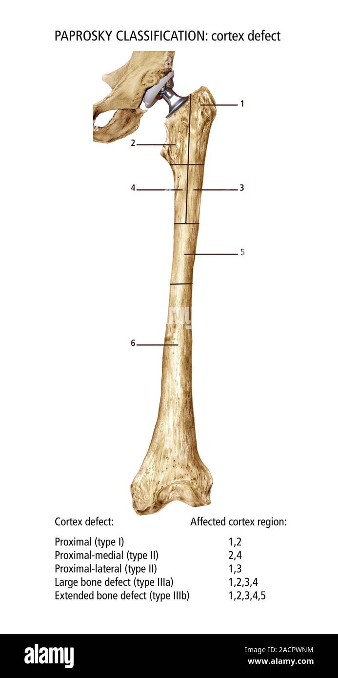 Paprosky femur defect classification. Diagram showing the ...