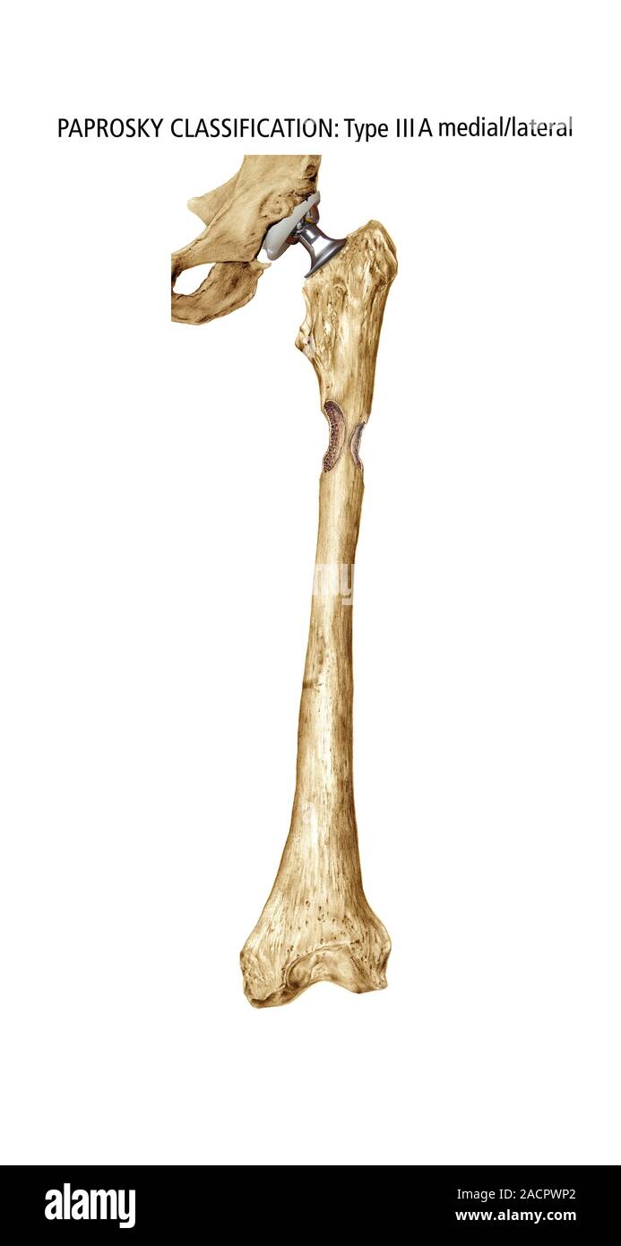 Paprosky femur defect. Artwork of bone degradation in a type IIIA ...