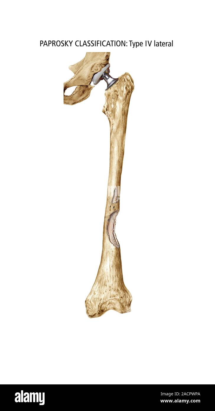Paprosky femur defect. Artwork of bone degradation in a type IV lateral ...