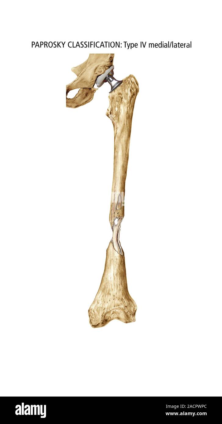 Paprosky femur defect. Artwork of bone degradation in a type IV medial ...
