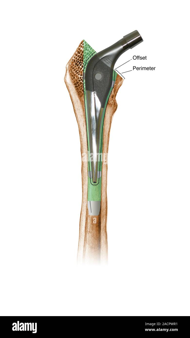 Prosthetic hip joint. Cutaway diagram of a femur (thigh bone) showing a ...