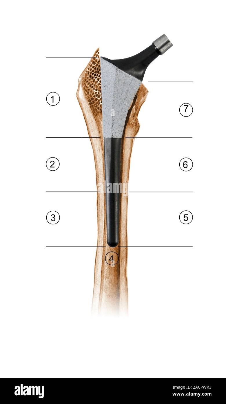 Prosthetic hip joint and Gruen zones. Cutaway diagram of a femur (thigh ...