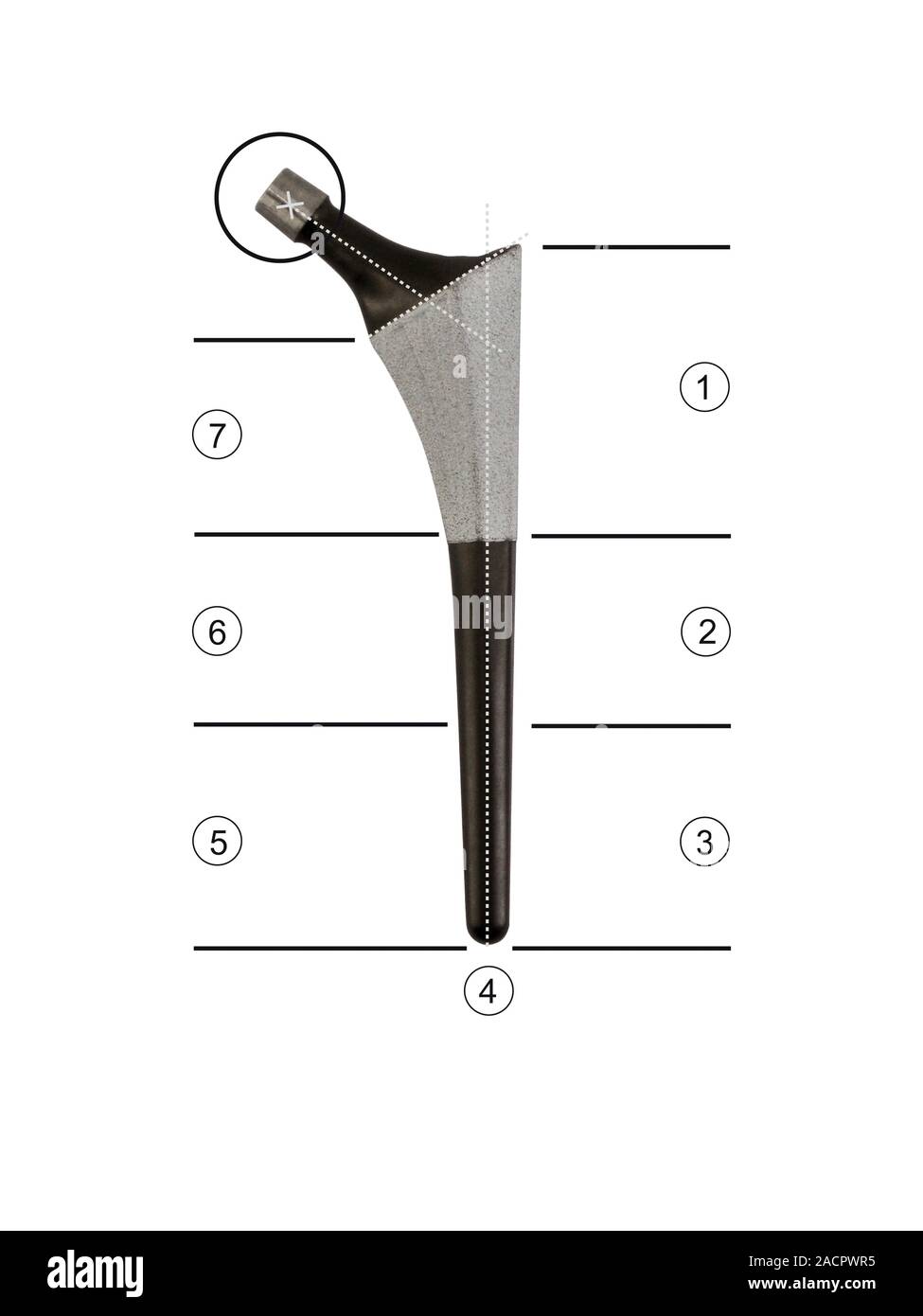 Prosthetic hip joint and Gruen zones. Diagram of the femoral component ...