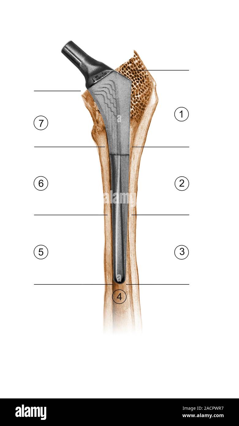 Prosthetic hip joint and Gruen zones. Cutaway diagram of a femur (thigh ...