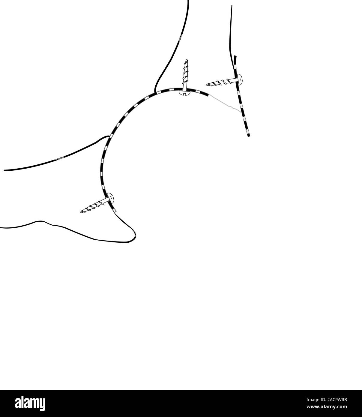 Hip socket bone grafting. Diagram showing the first stage in hip socket ...