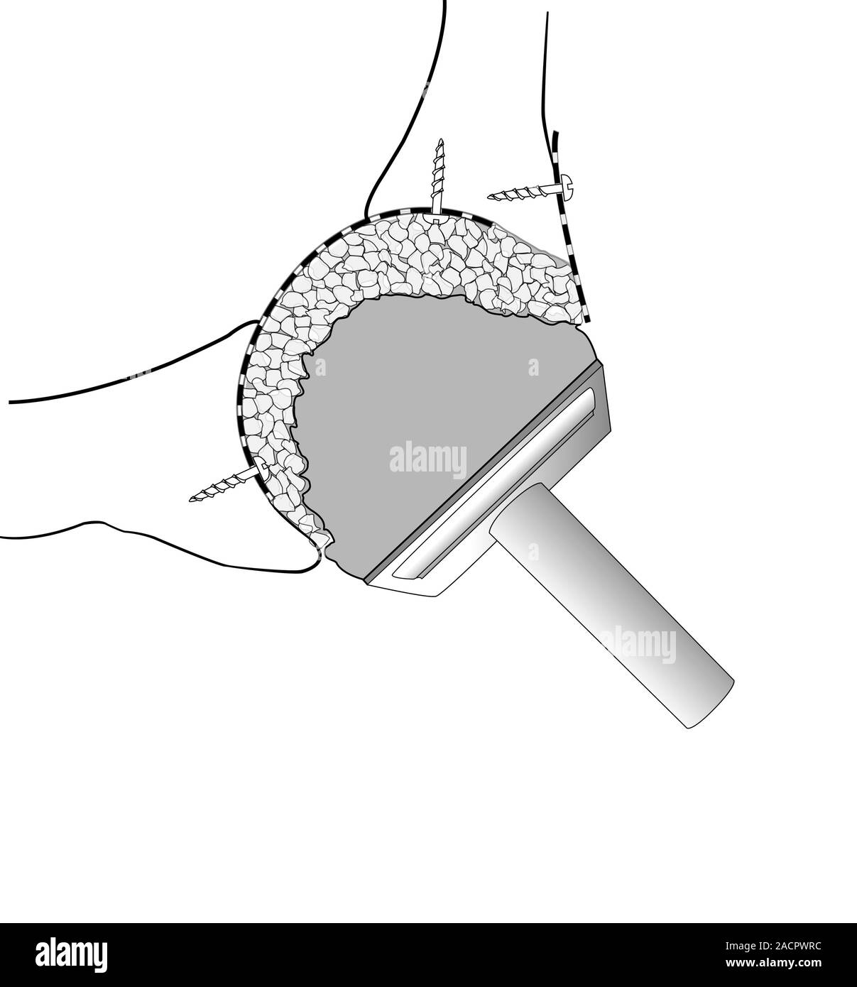 Hip socket bone grafting. Diagram showing the third stage in hip socket ...
