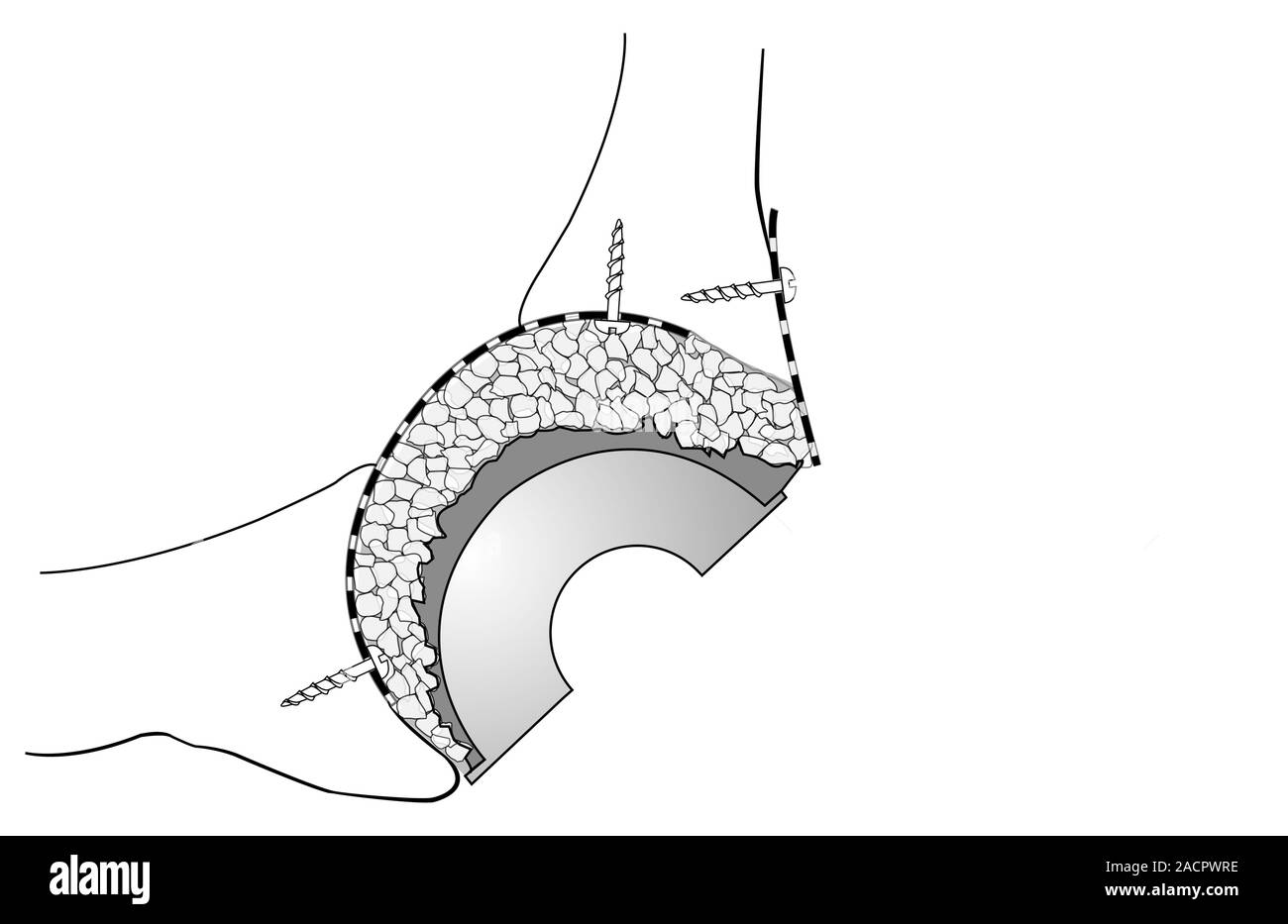 Hip socket bone grafting. Diagram showing completed hip socket bone ...