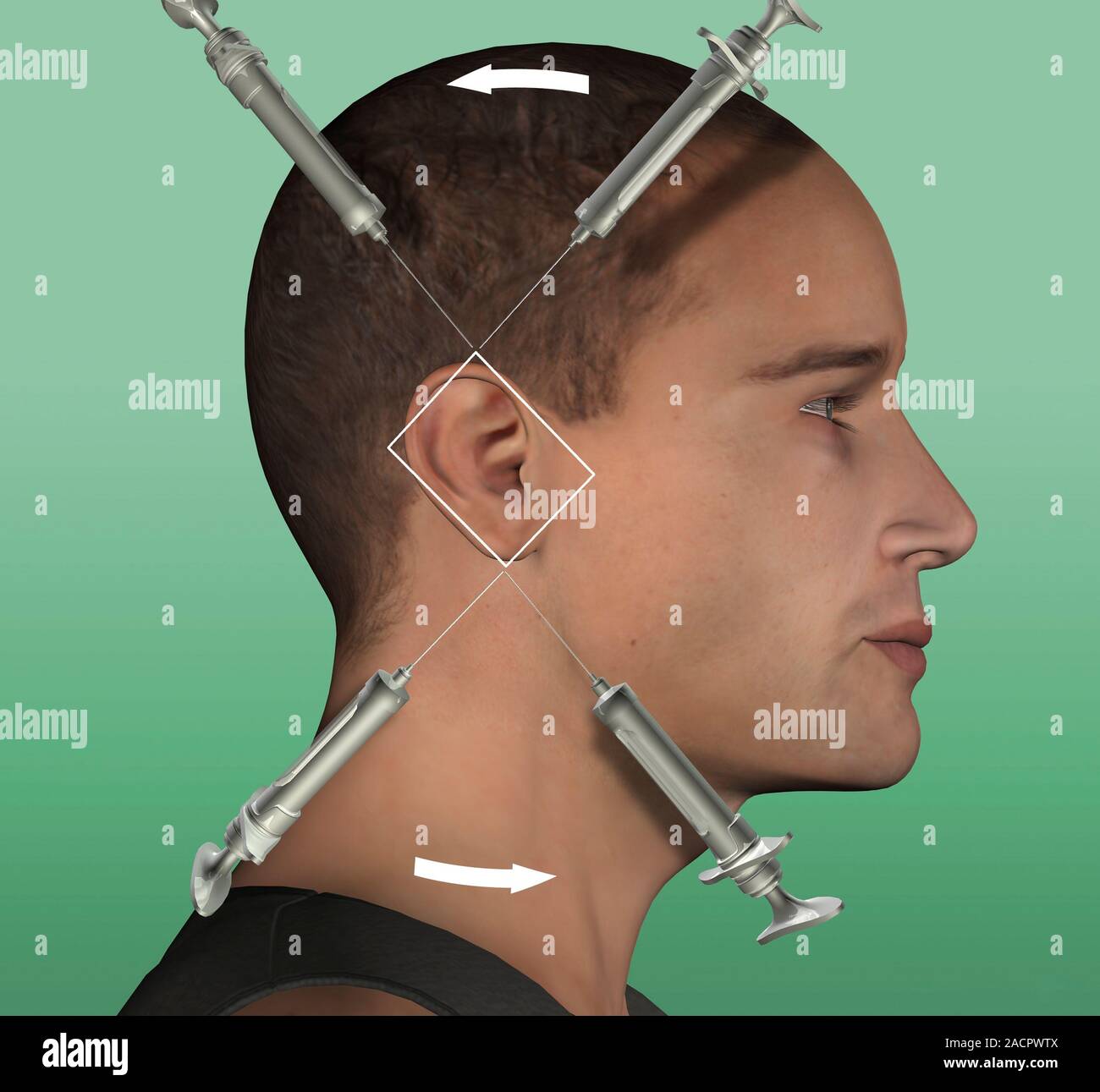 Ear nerve block. Artwork of syringes being used to inject local ...