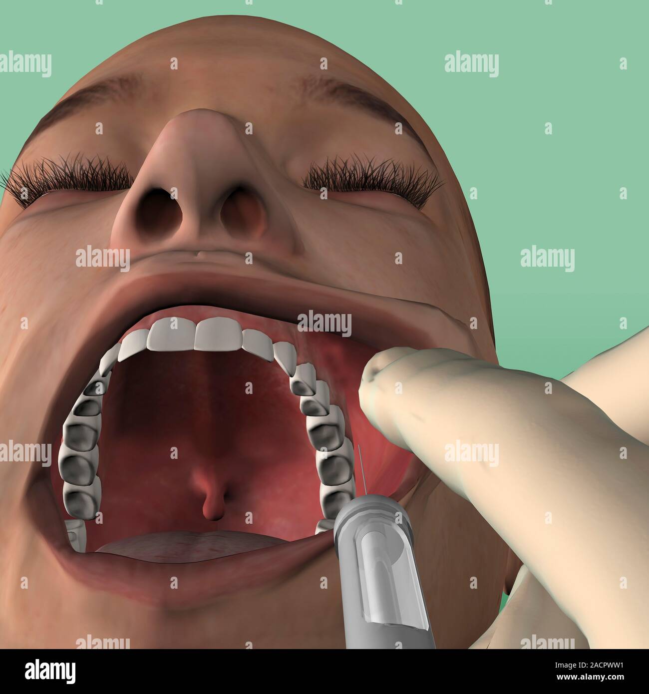 Posterior superior alveolar nerve block. Artwork of a syringe being ...