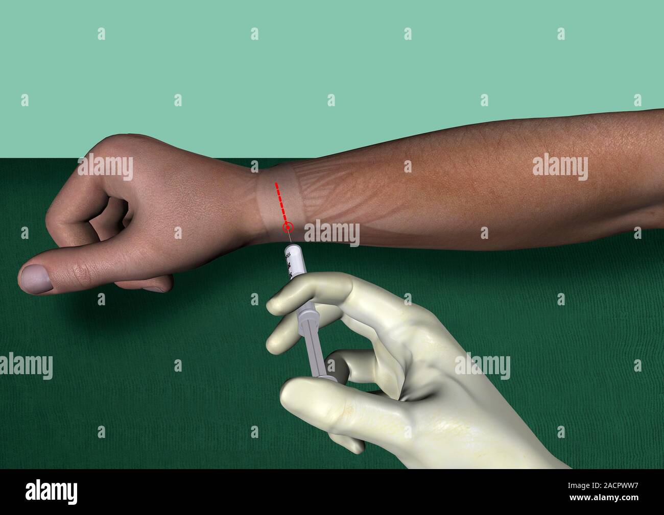Radial nerve wrist block. Artwork of a syringe being used to inject a ...