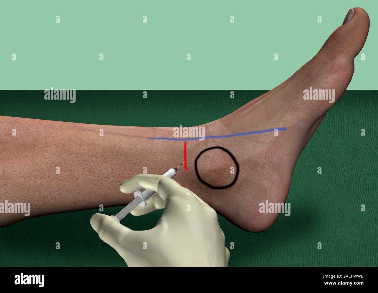 Saphenous nerve block. Artwork of a syringe being used to inject a ...