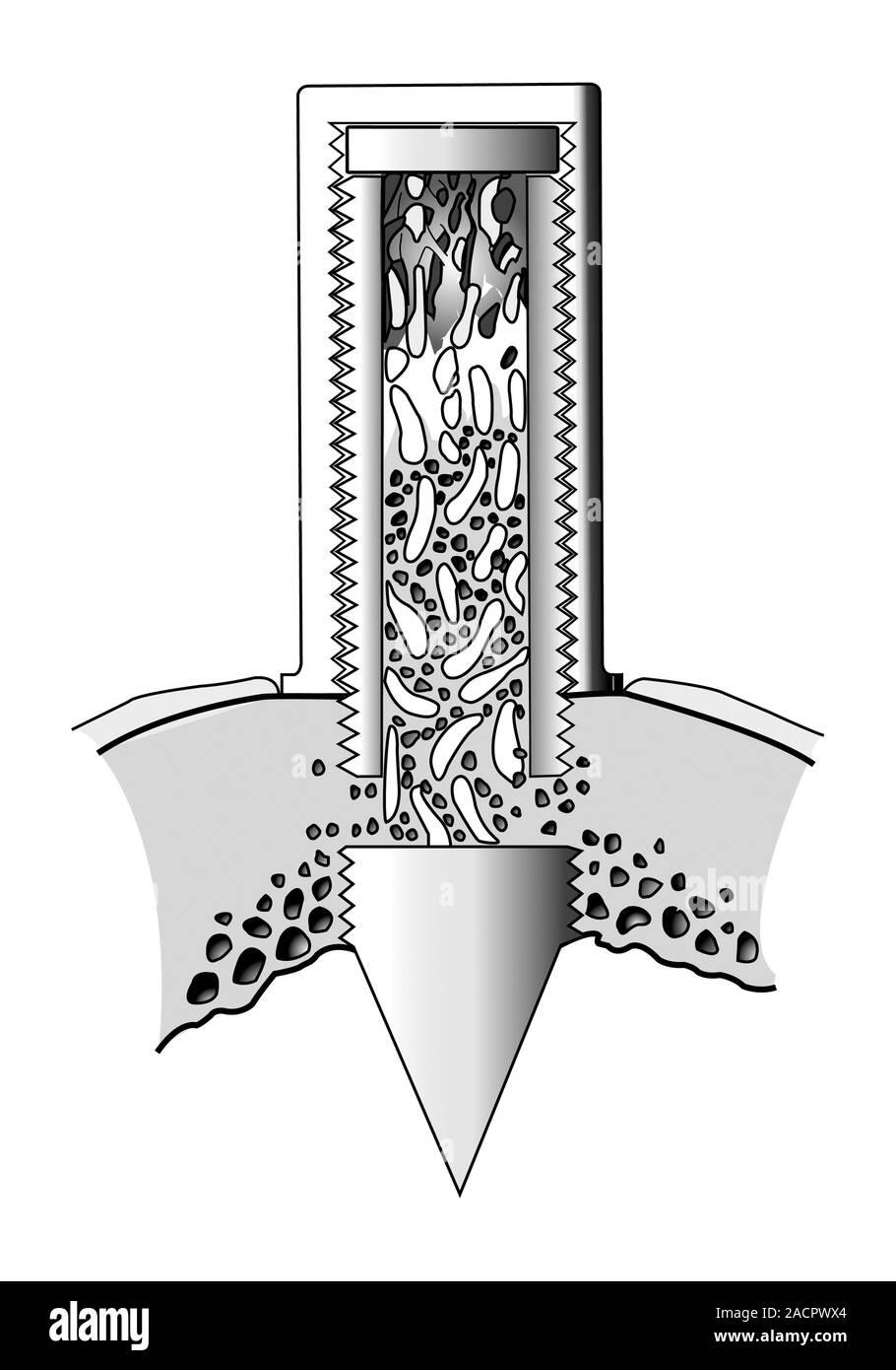 Bone drill and grafter. Artwork of a cross-section through a bone drill ...