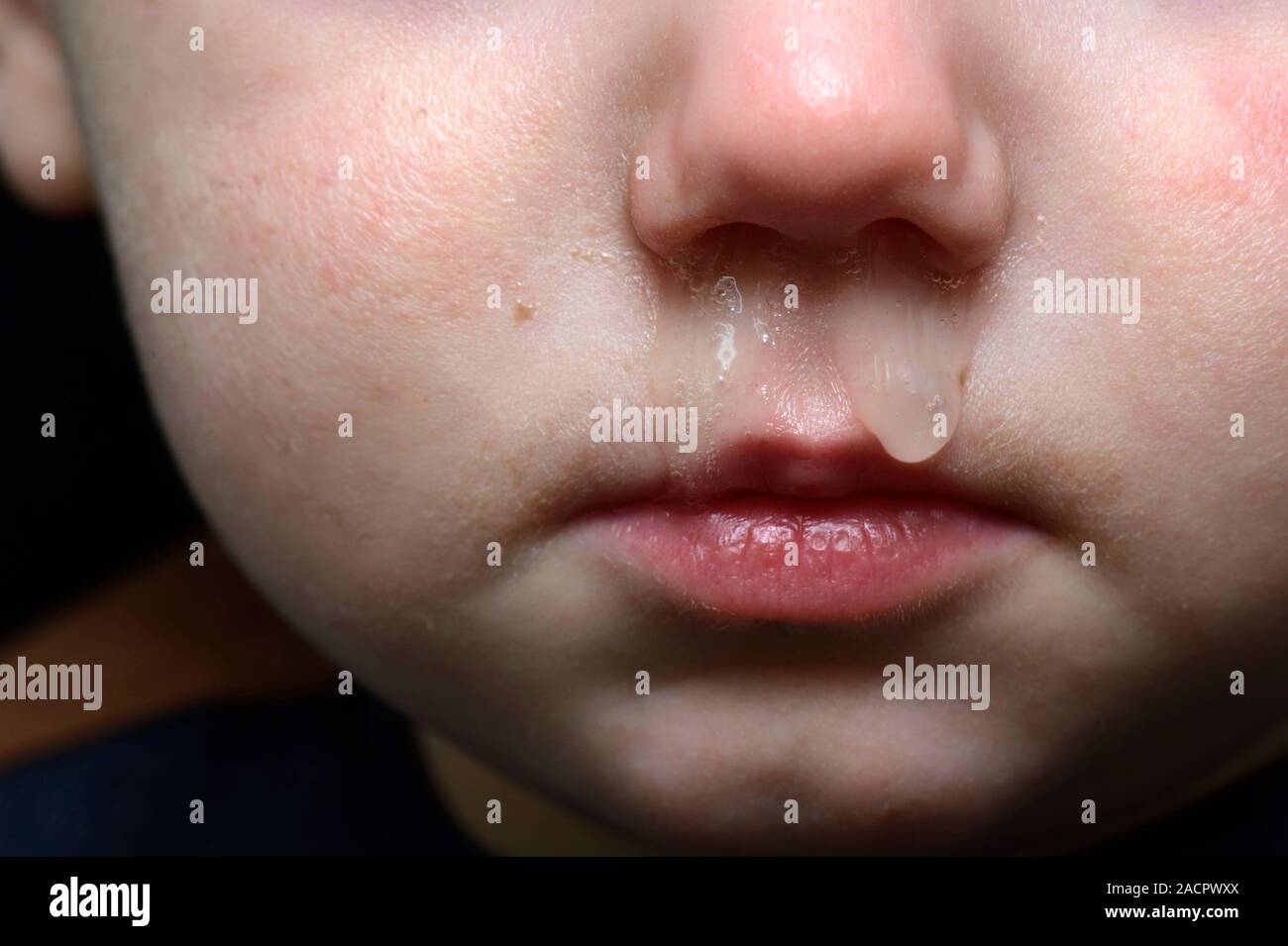 Not for use in Television Not for use in Television Snotty child with a ...