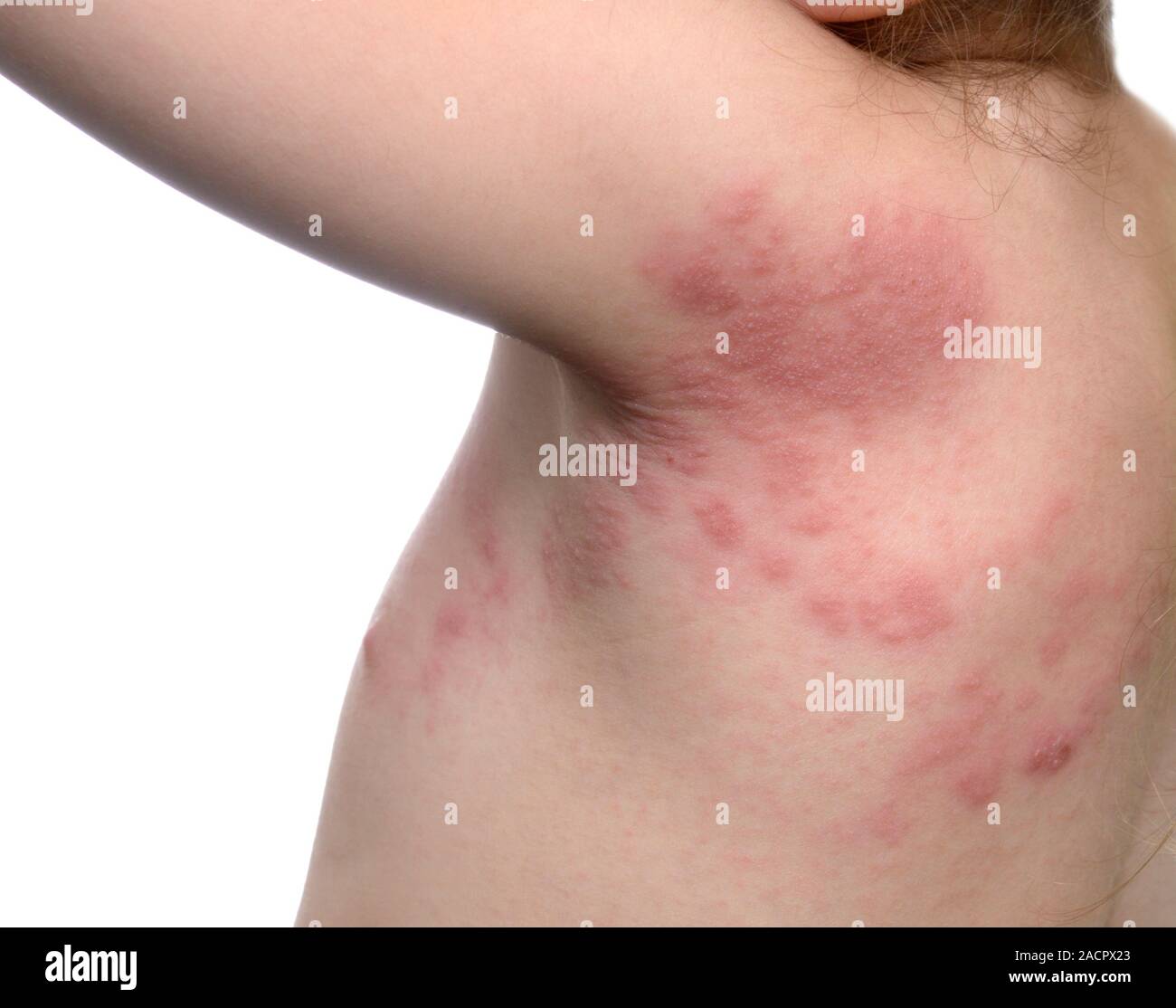 Not for use in Television Not for use in Television Shingles rash in a ...