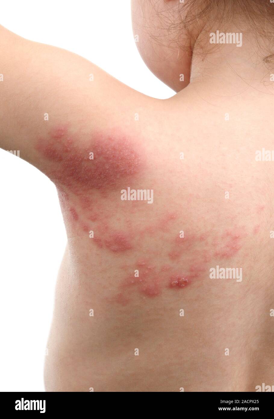 Not for use in Television Not for use in Television Shingles rash in a ...