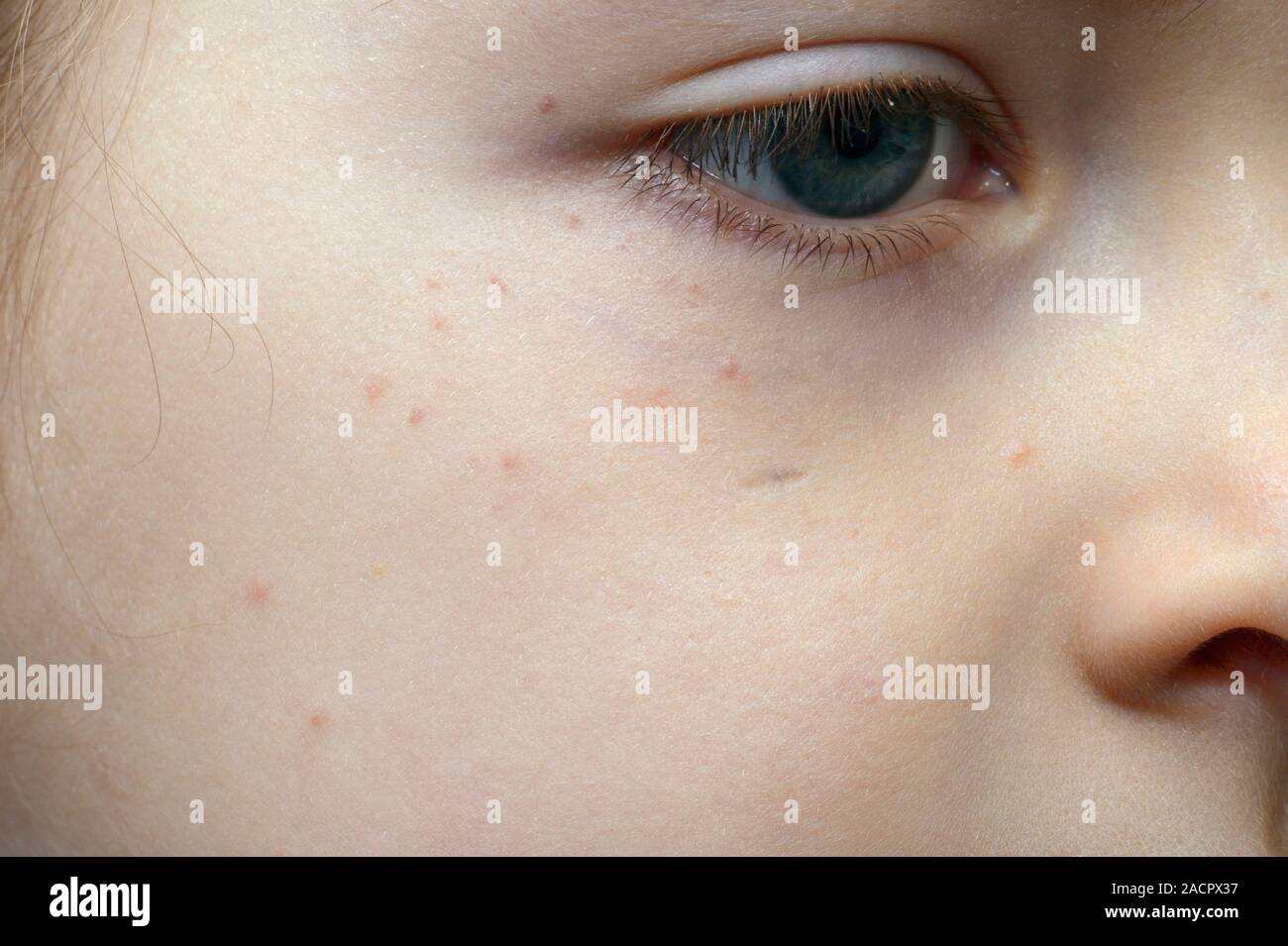 Not for use in Television Not for use in Television Purpura rash around ...