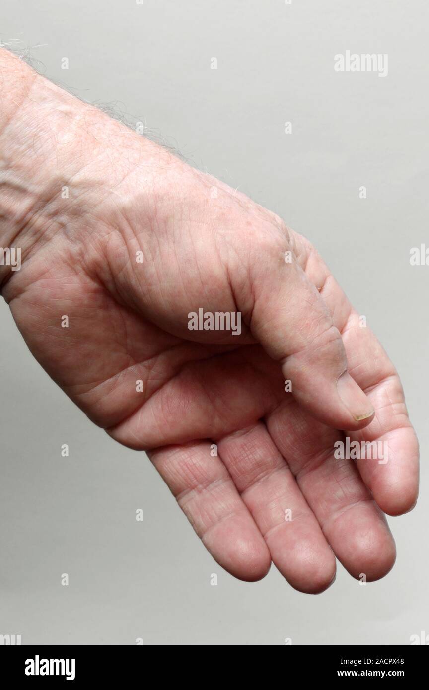 Not for use in Television Not for use in Television Carpal tunnel ...