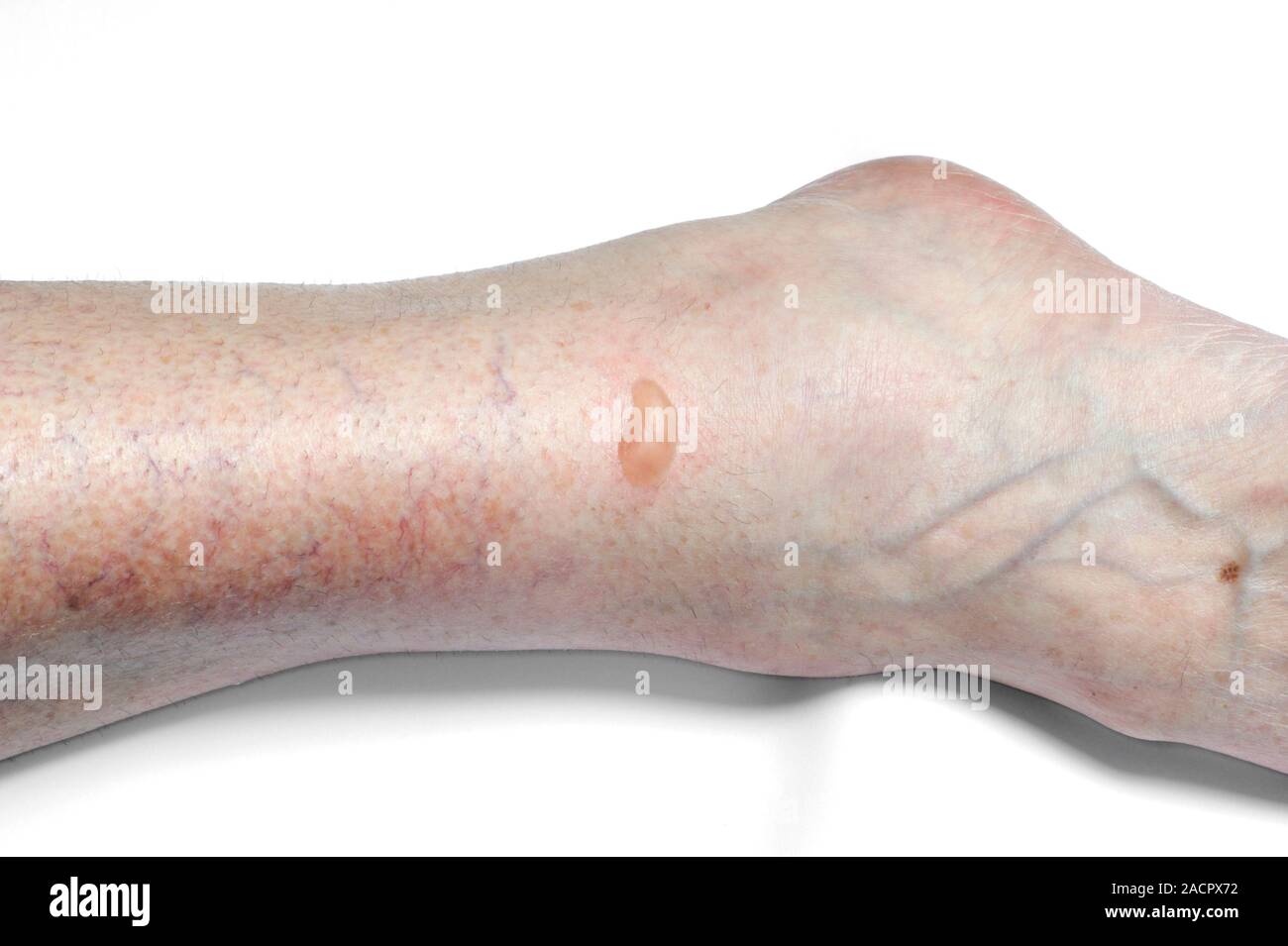 Not for use in Television Not for use in Television Blister and ...