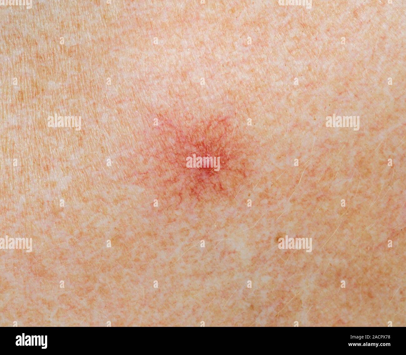 Not for use in Television Not for use in Television Spider naevus on ...