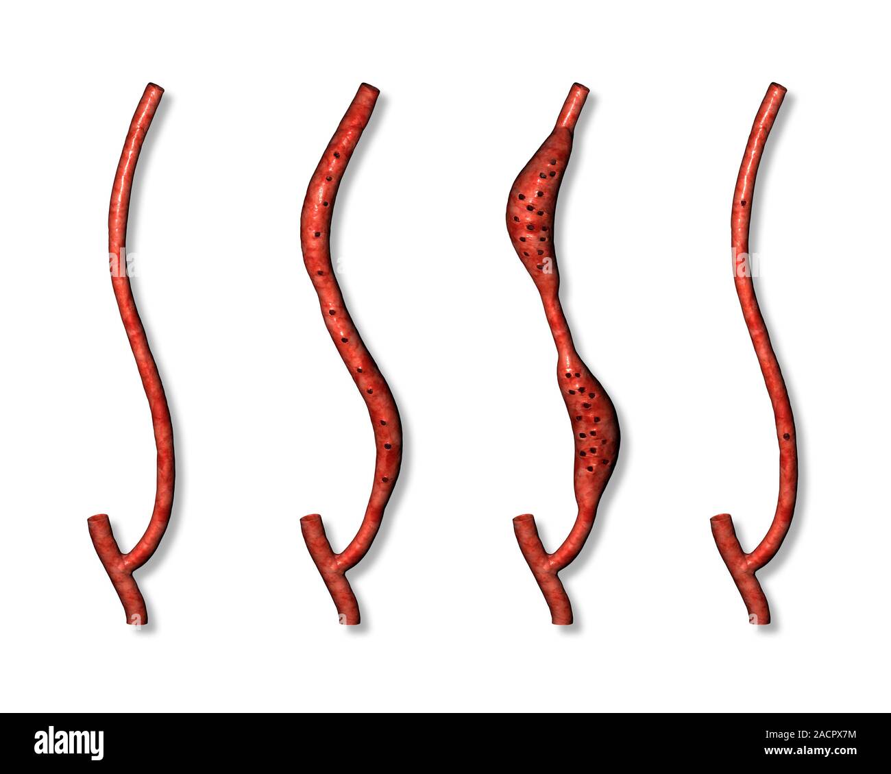 Cannulation techniques. Artwork showing various veins and a range of ...