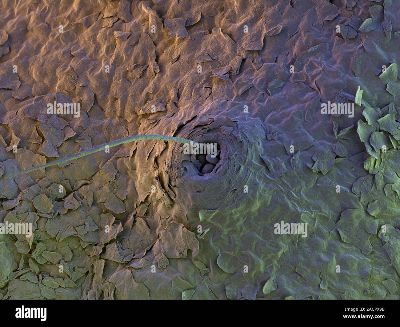 Mite on human skin. Coloured scanning electron micrograph (SEM) of ...