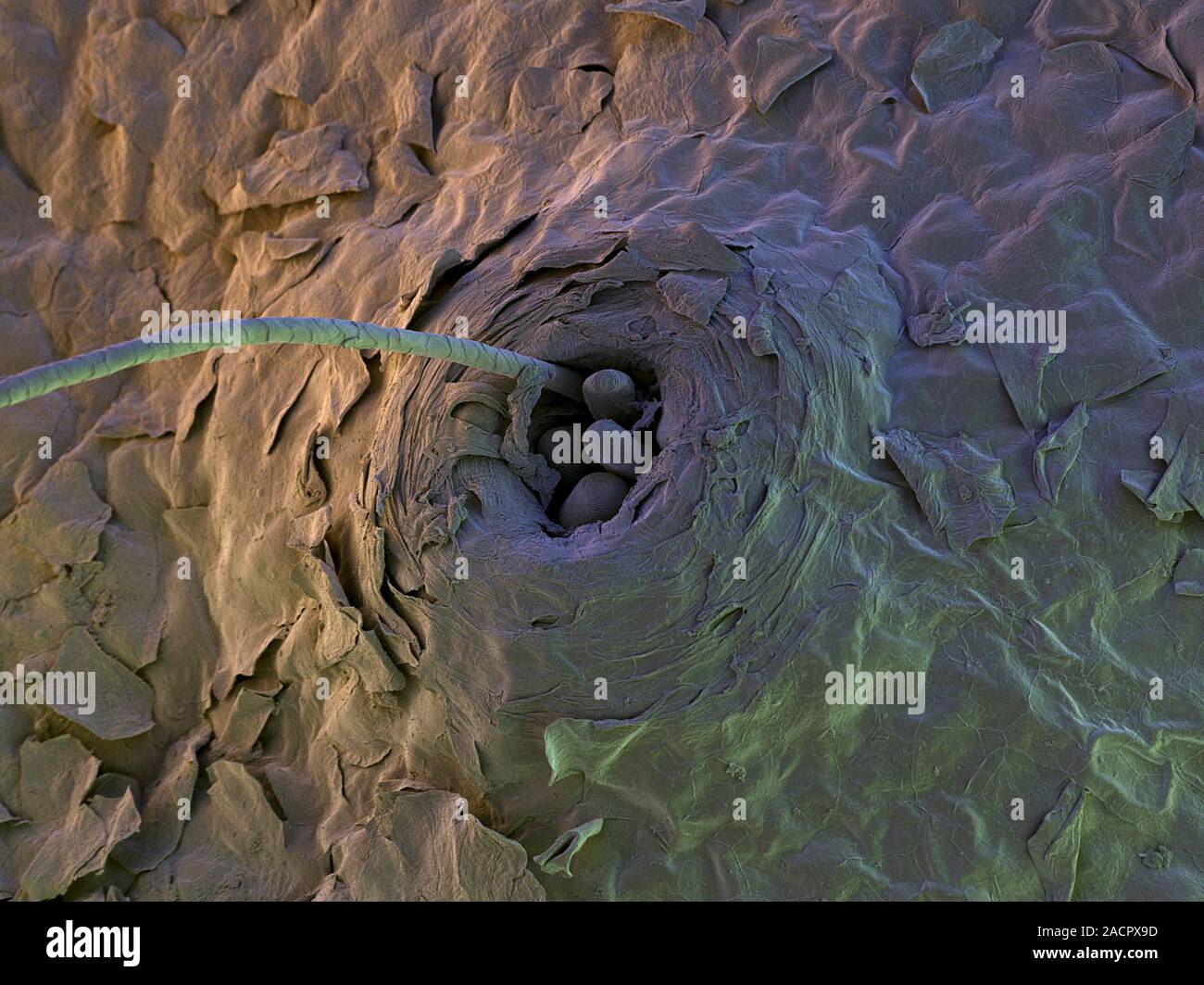 Mite on human skin. Coloured scanning electron micrograph (SEM) of ...