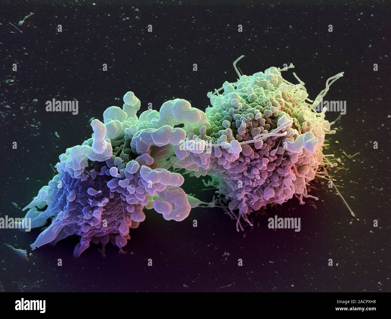 Lymphoblast white blood cells. Coloured scanning electron micrograph ...