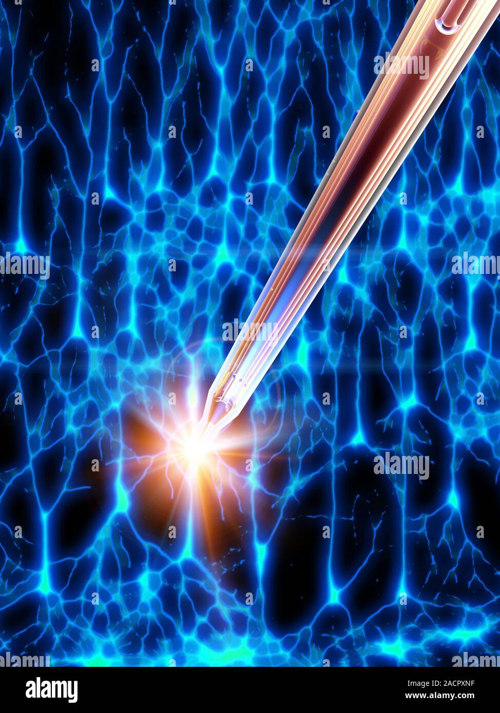 Deep brain stimulation (DBS). Computer artwork showing an electrode ...