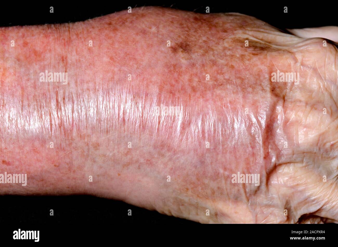 Close-up of the red and inflamed wrist of a 93 year old female patient ...