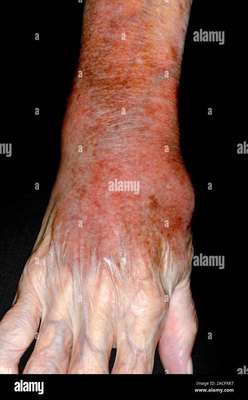 Red and inflamed wrist of a 93 year old female patient with cellulitis ...