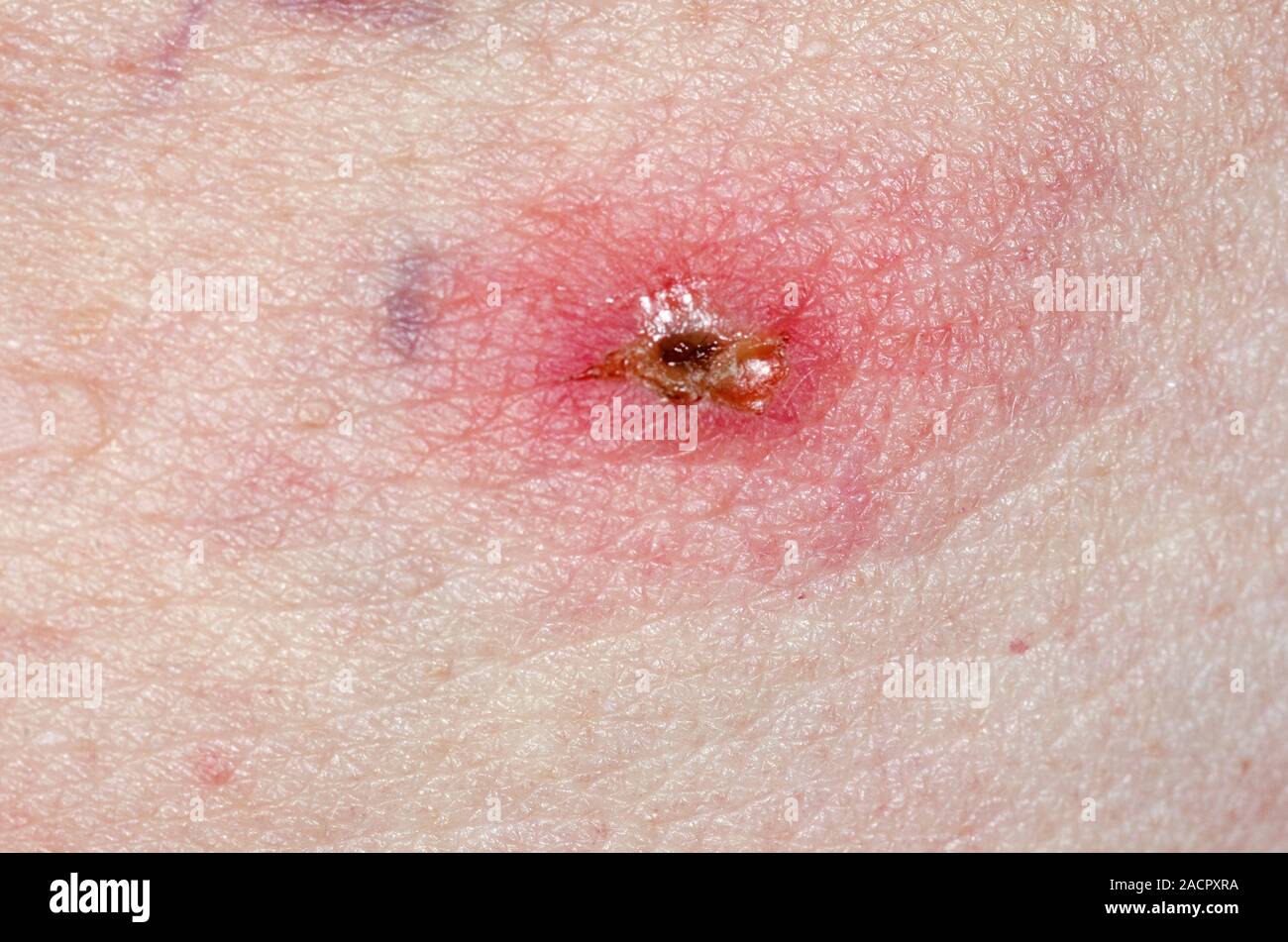 Close-up of an infected tick bite on the skin of a 70 year old female ...