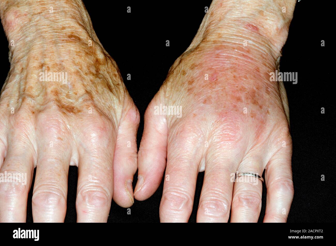Red skin on the swollen hand (at right) of an 82 year old female ...