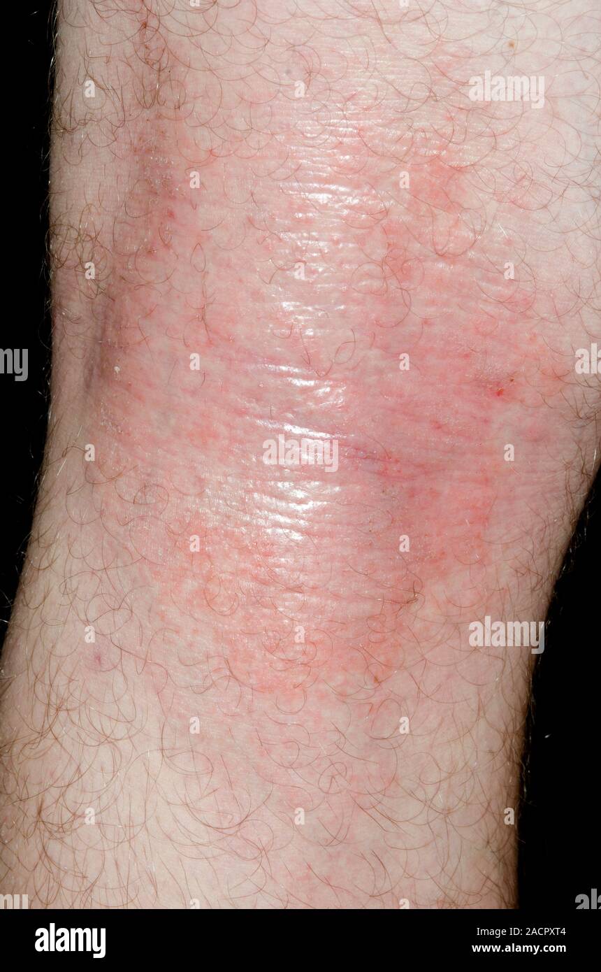 Close-up of red and inflamed skin behind the knee of a 19 year old male patient with atopic ...