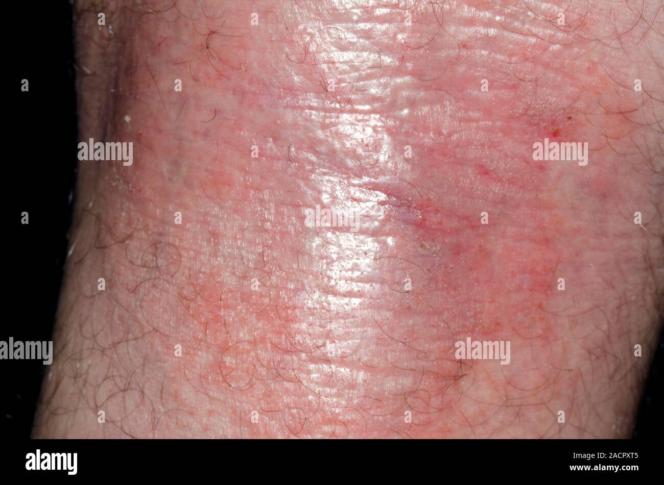 Close-up of red and inflamed skin behind the knee of a 19 year old male ...