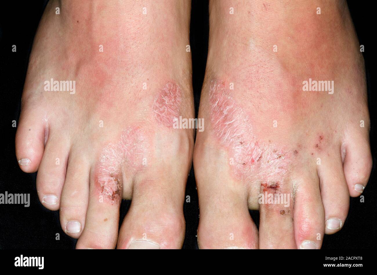 Red and cracked skin on the feet of a 14 year old male patient due to ...