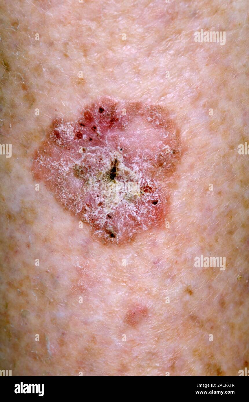Close-up of a skin lesion on the shin of the leg of an 82 year old ...