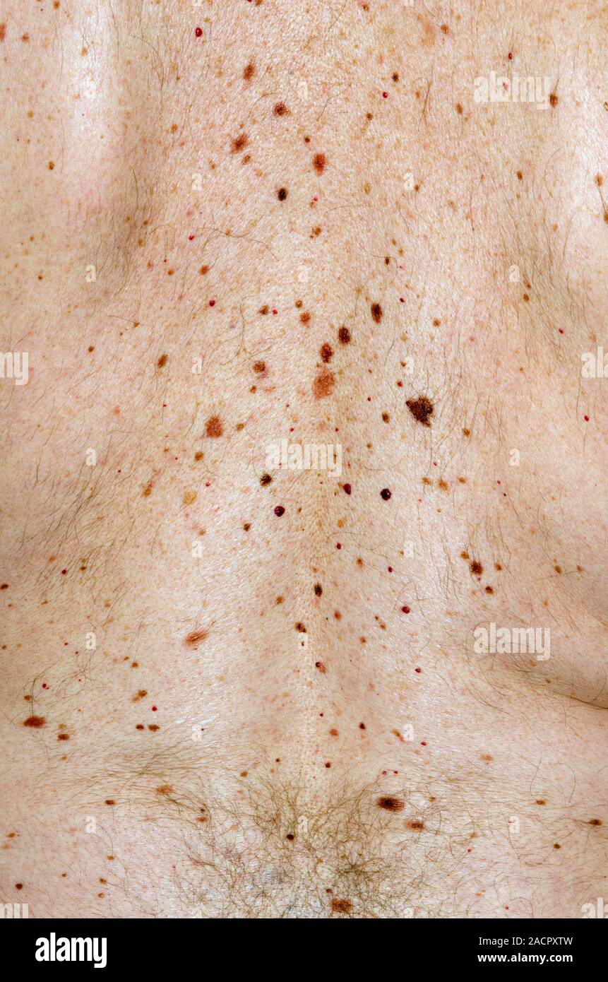Multiple benign naevi (moles) and Campbell de Morgan spots (cherry ...