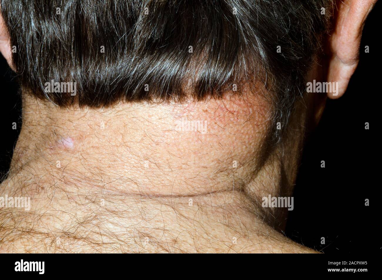 Swelling at the back of the neck of a 79 year old male patient due to a ...