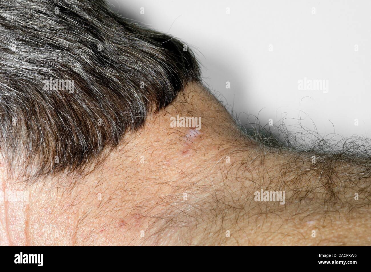 Swelling at the back of the neck of a 79 year old male patient due to a ...