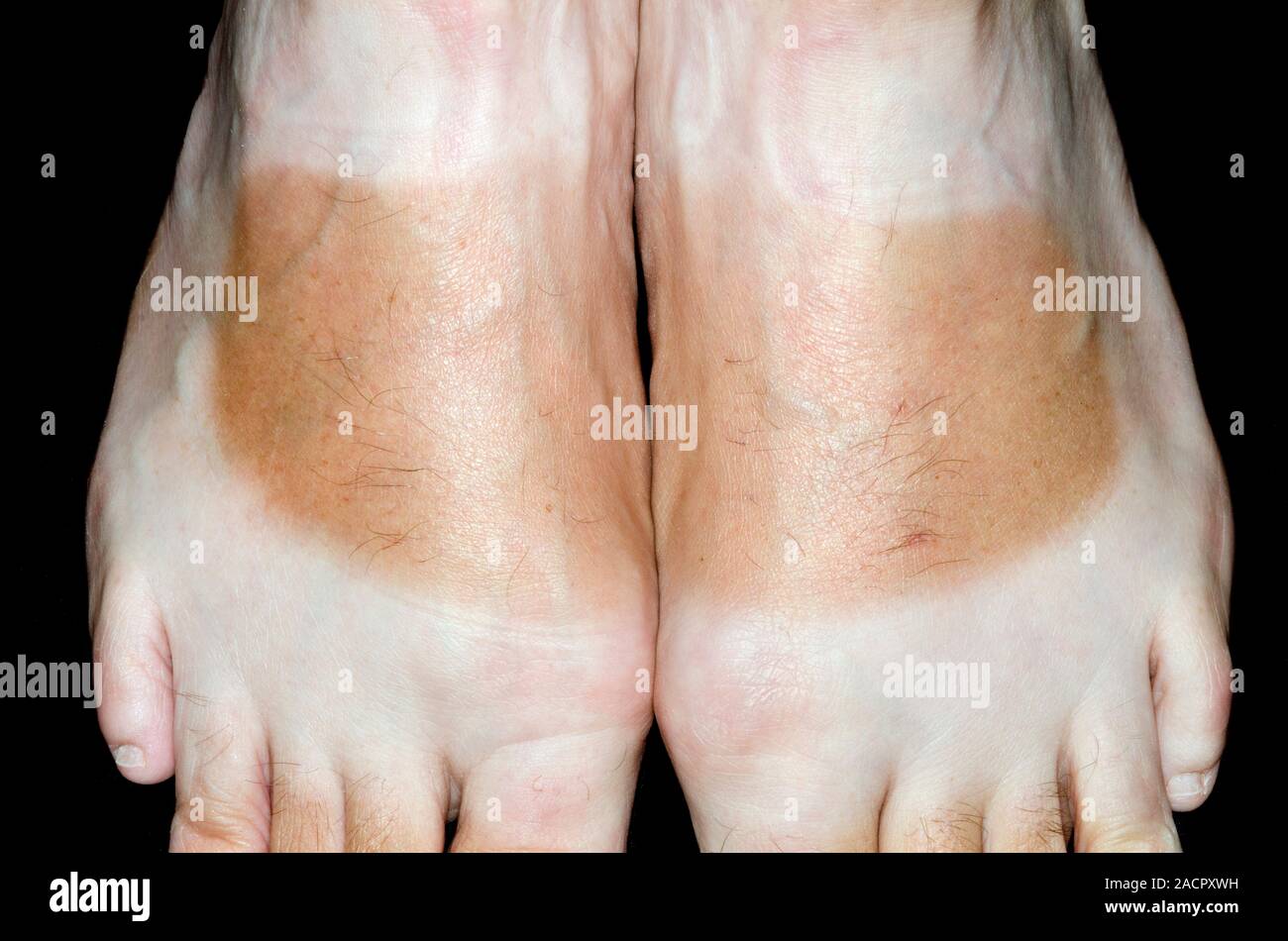 Sunburned feet of a 61 year old male patient after wearing sandals in ...