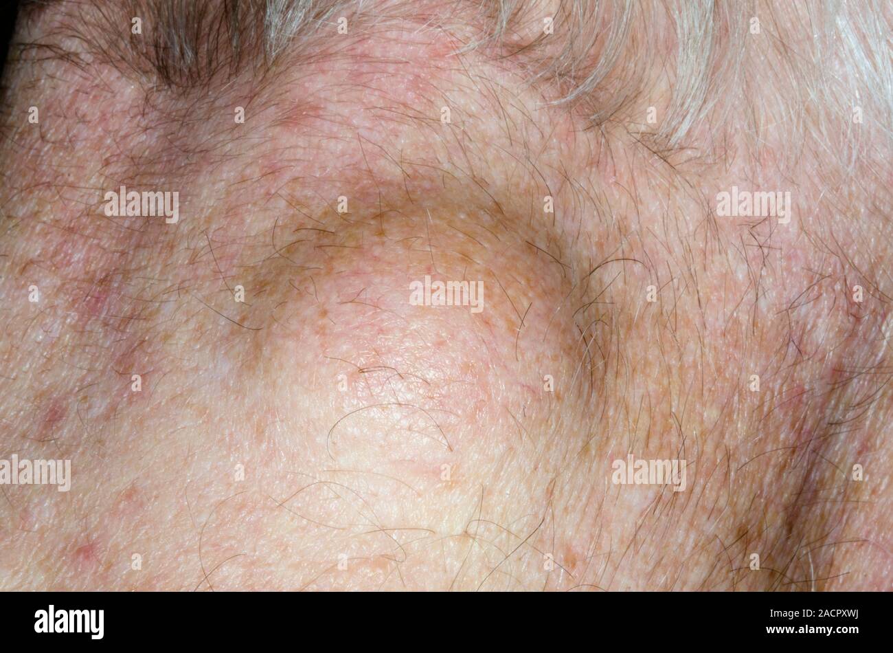 Sebaceous cyst on the back of the neck of an 82 year old male patient ...