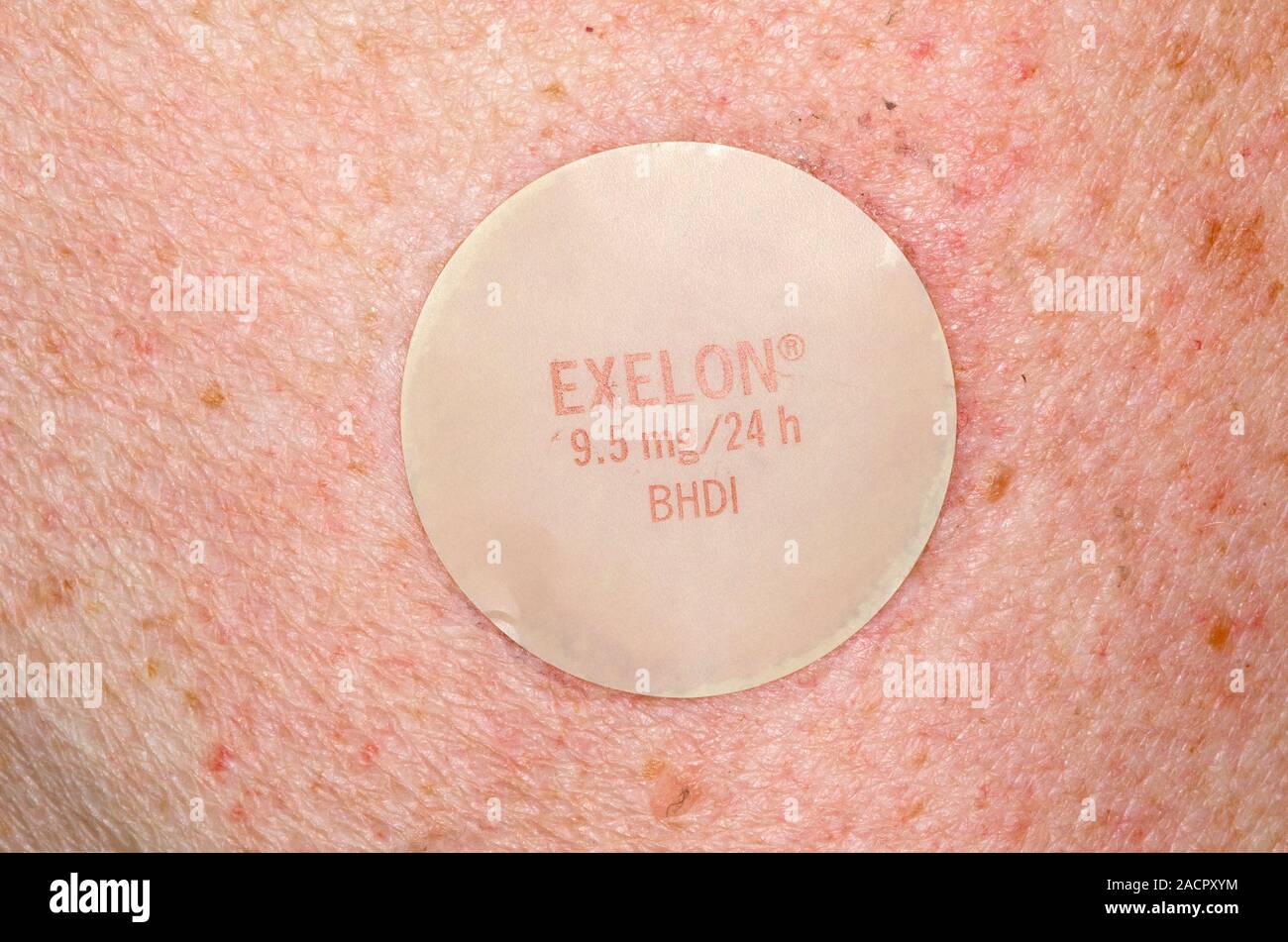 Skin patch containing the drug Exelon (Rivastigmine), a cholinesterase ...